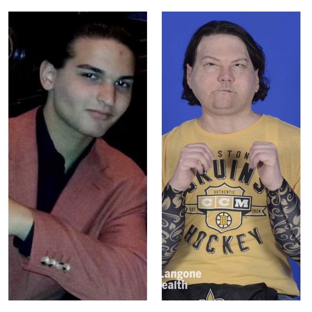 Víctima de un accidente de tránsito recibe el primer trasplante de cara ...